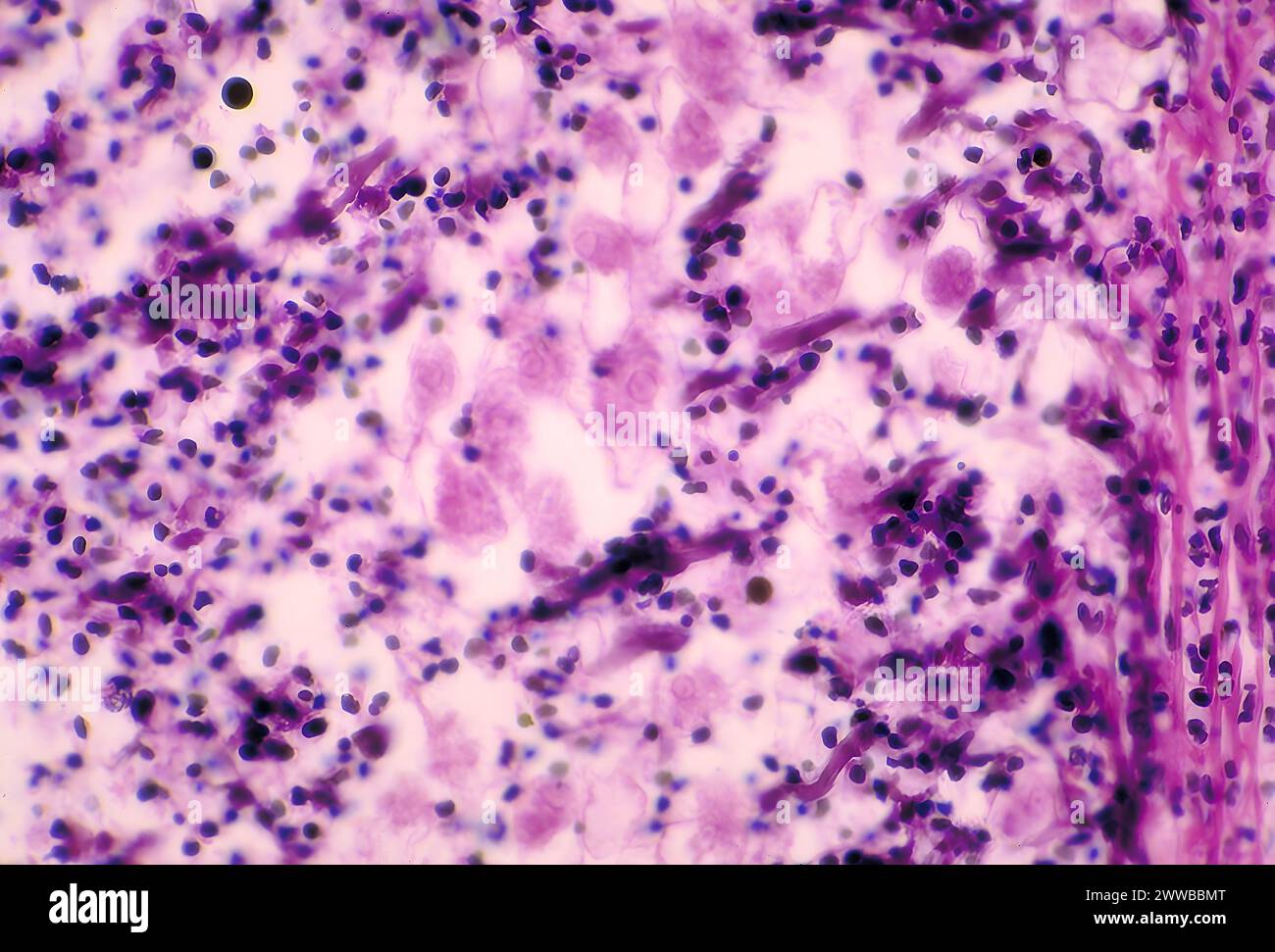 Histopathologic characteristics hi-res stock photography and images - Alamy Histopathologic characteristics hi-res stock photography and images - Alamy