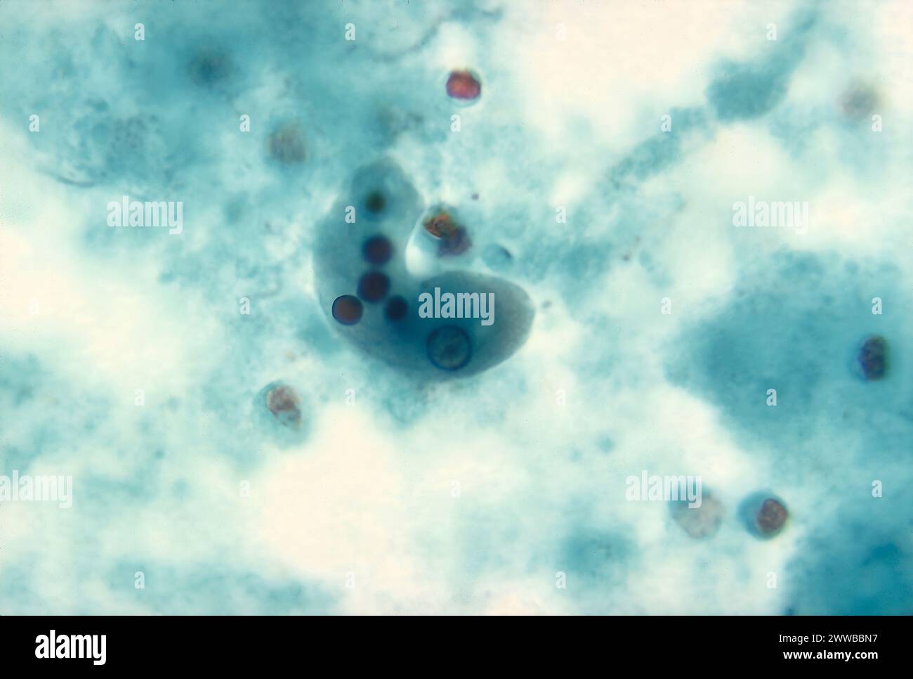 This photomicrograph revealed a protozoan parasite Entamoeba ...