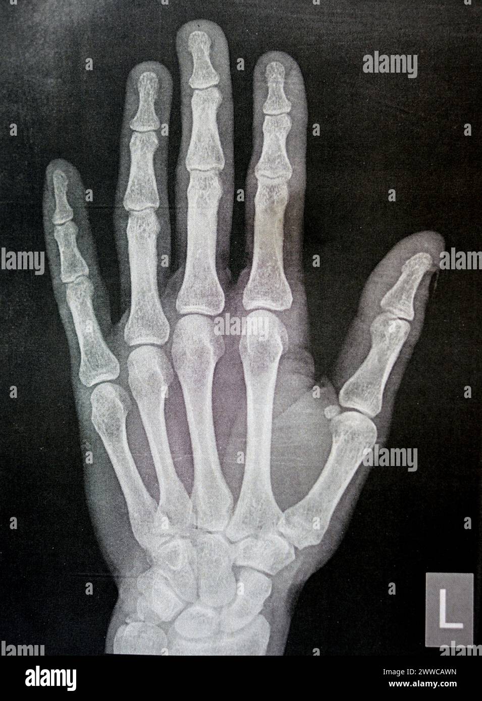 Right Hand X Ray Normal