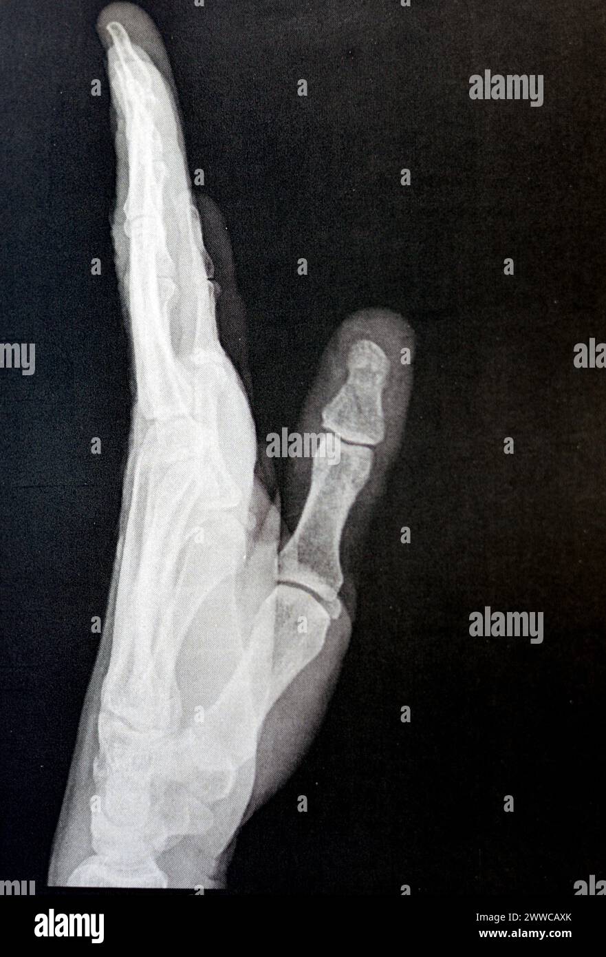 Thumb x ray hi-res stock photography and images - Alamy