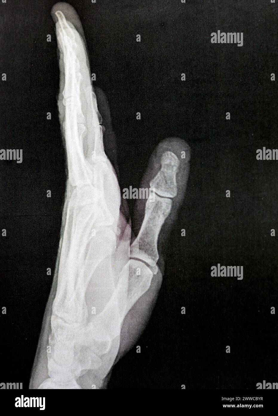 Thumb x ray hi-res stock photography and images - Alamy