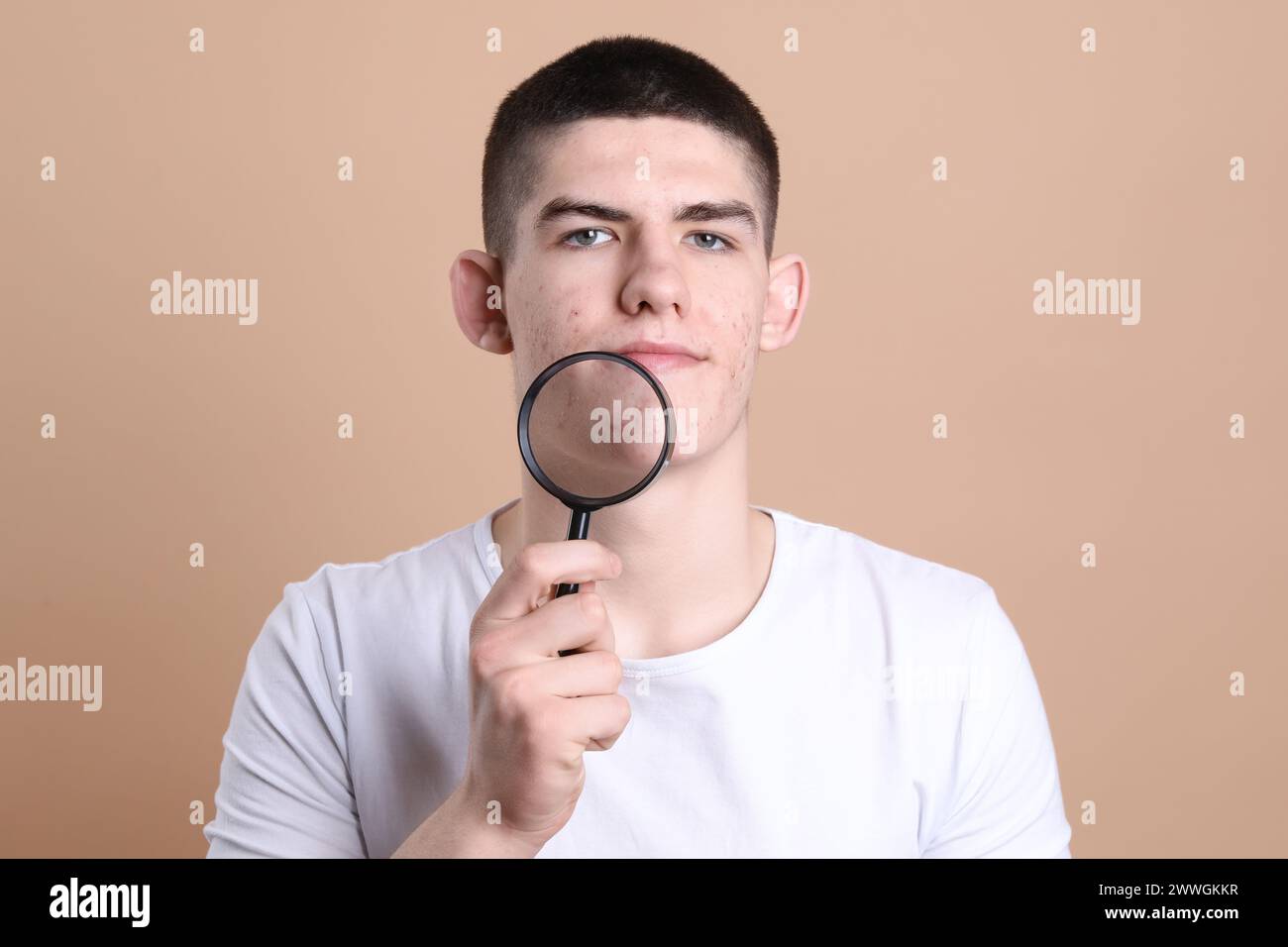Young man with acne problem holding magnifying glass on beige ...