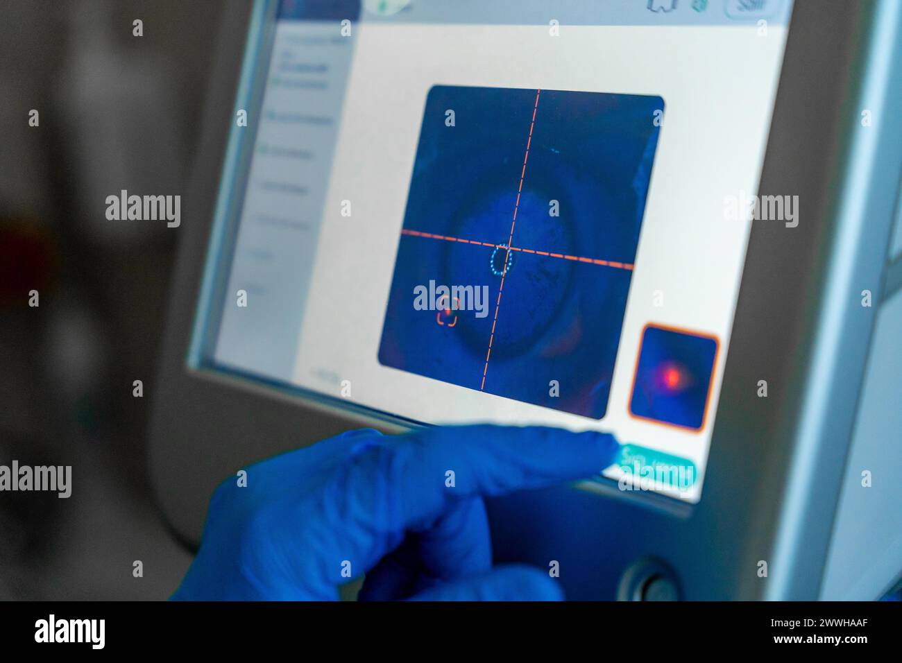 Screen used by the ophthalmologist to monitor the eye for laser ...