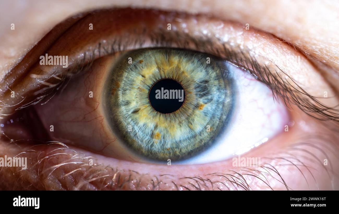 Description: Female Blue-Green Colored Eye with brown pigment spots ...