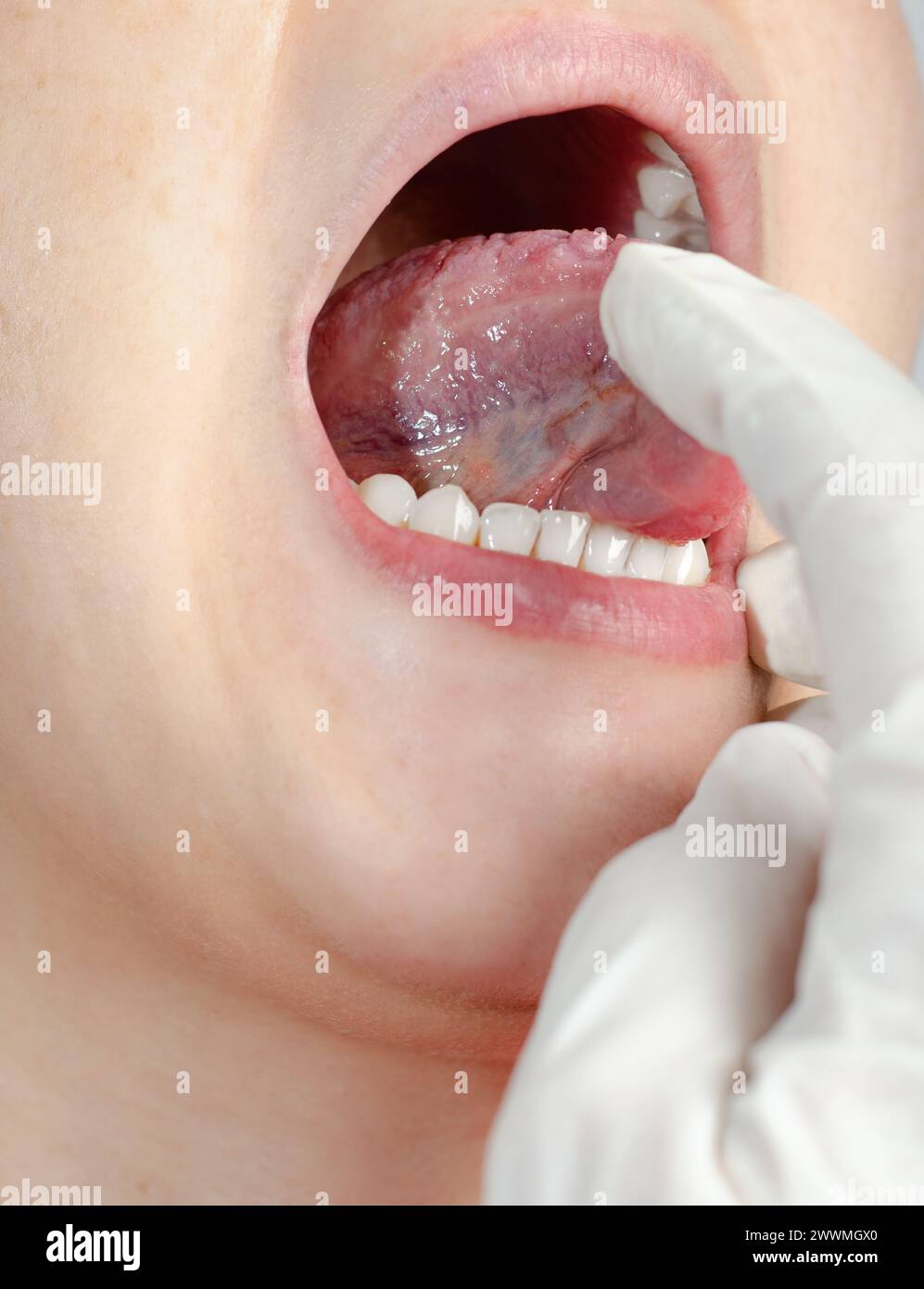 Woman doctor tongue hi-res stock photography and images - Alamy