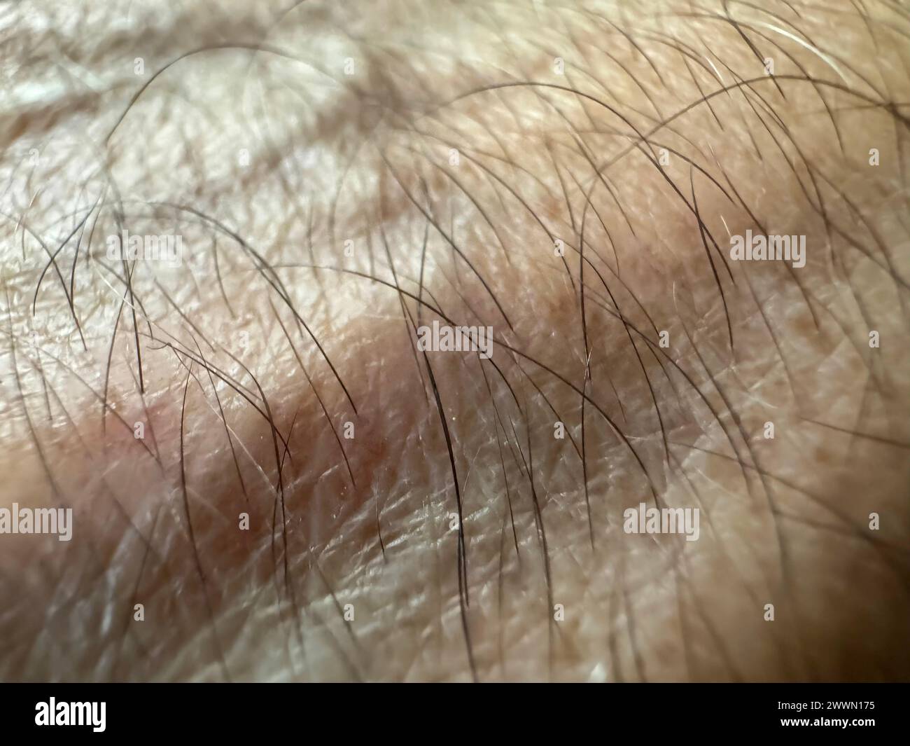 Hair on arm close up. Human skin texture macro photo. Healthy skin ...