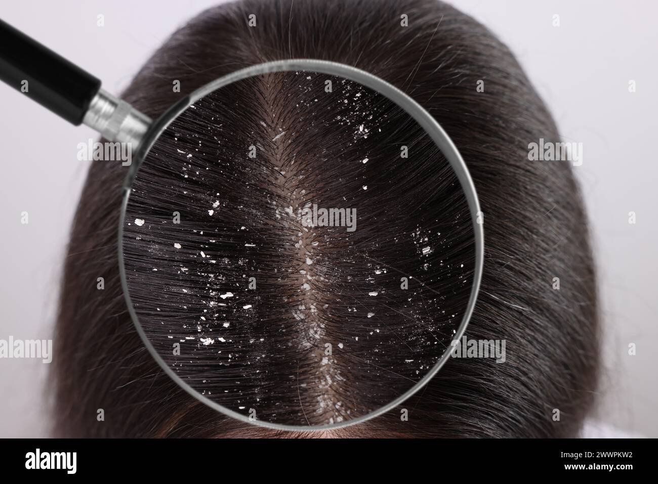 Woman suffering from dandruff on light background, closeup. View ...