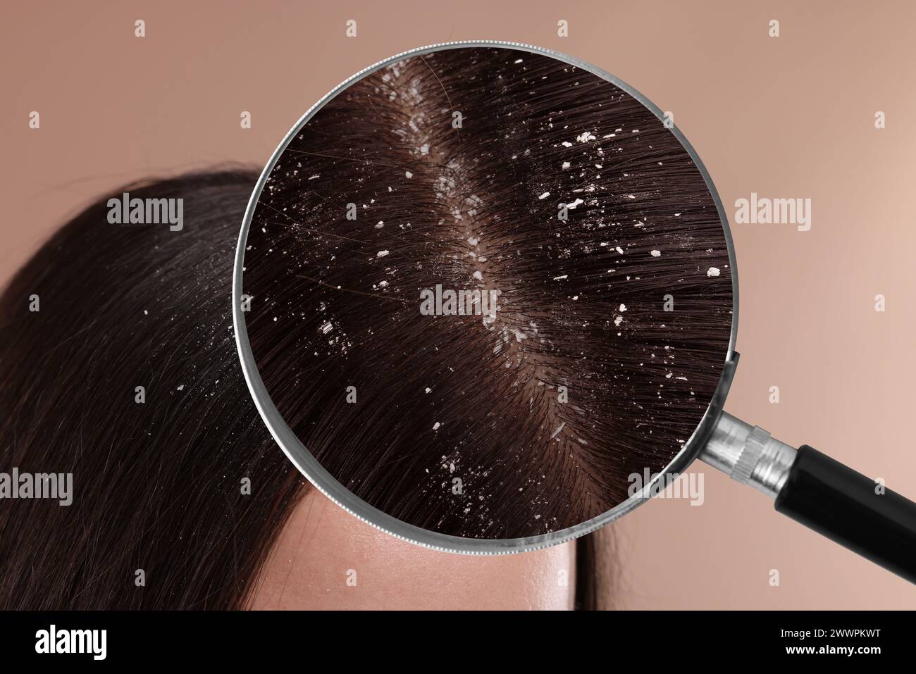 Woman suffering from dandruff on pale brown background, closeup. View ...