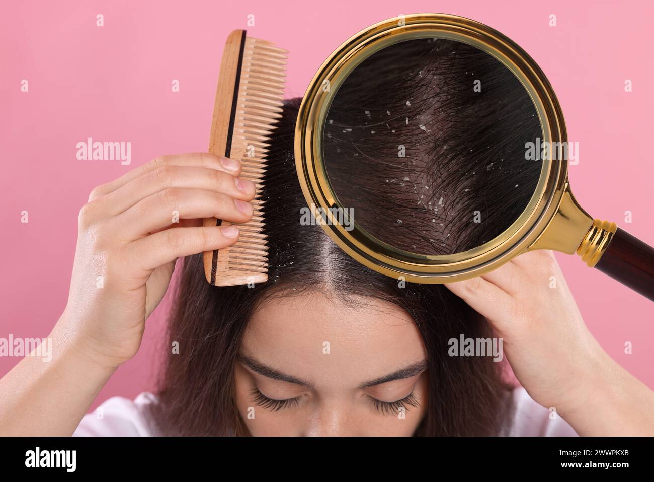Woman suffering from dandruff on pink background, closeup. View through ...
