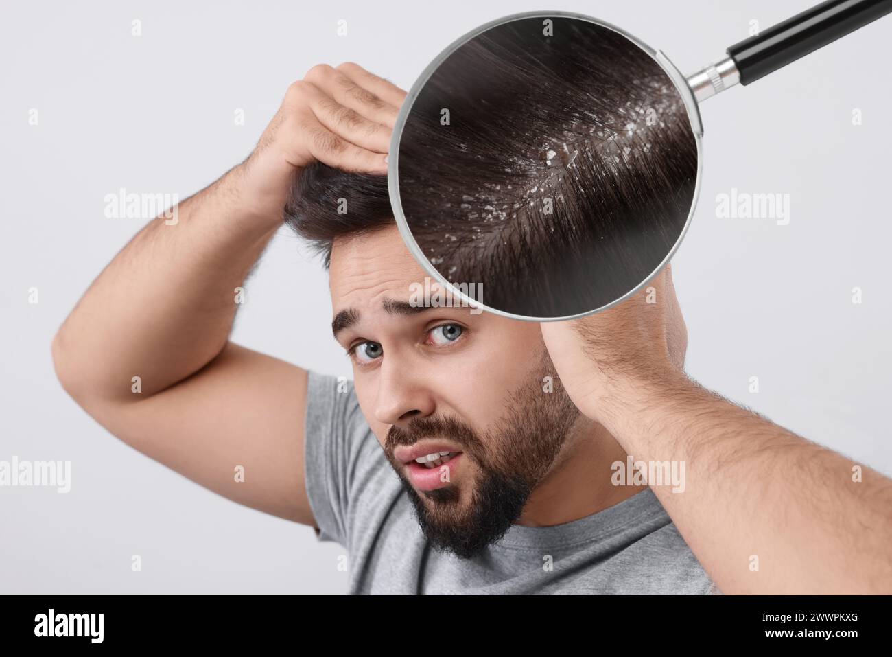Man suffering from dandruff on light grey background. View through ...