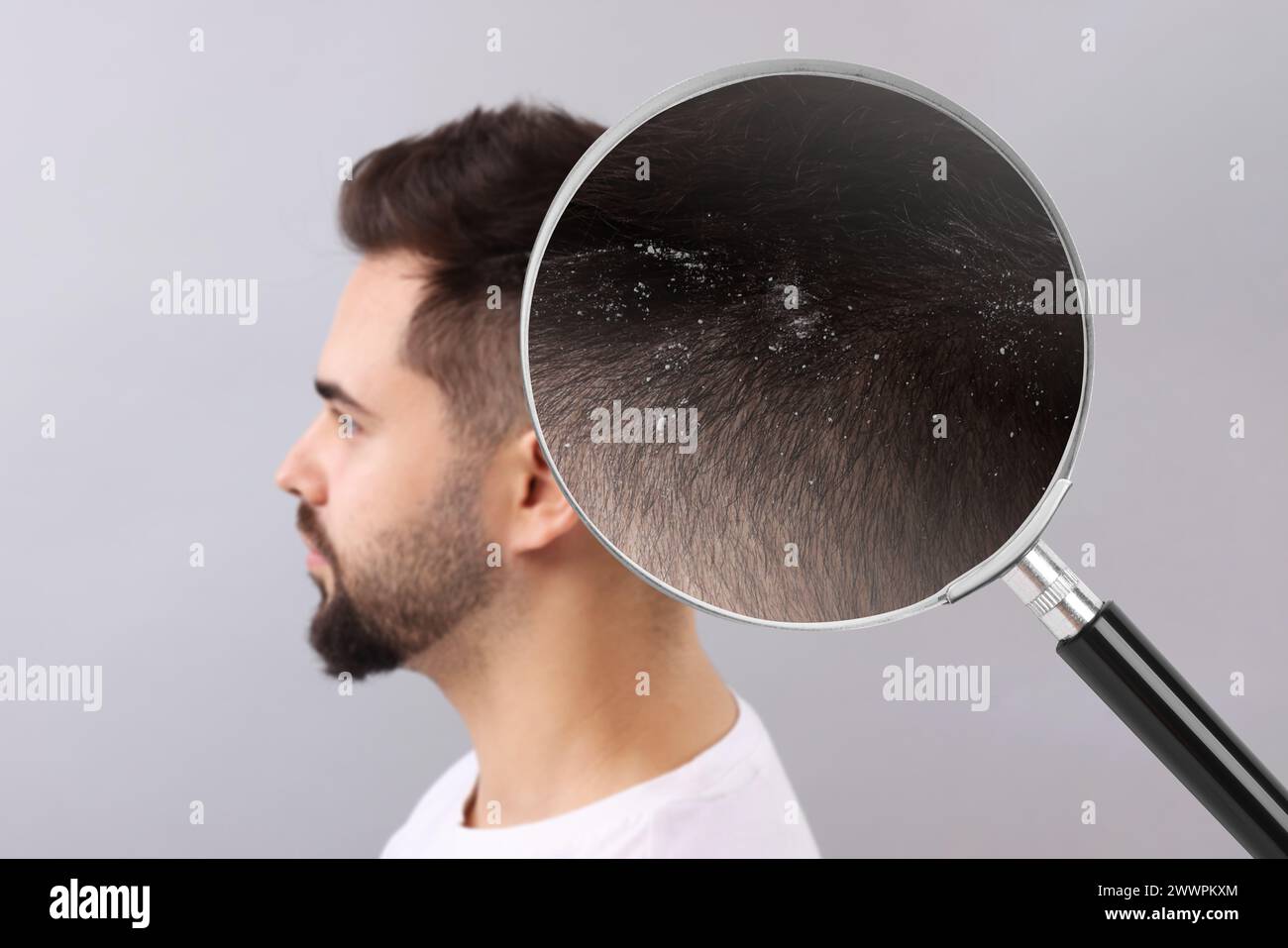 Man suffering from dandruff on light grey background. View through ...
