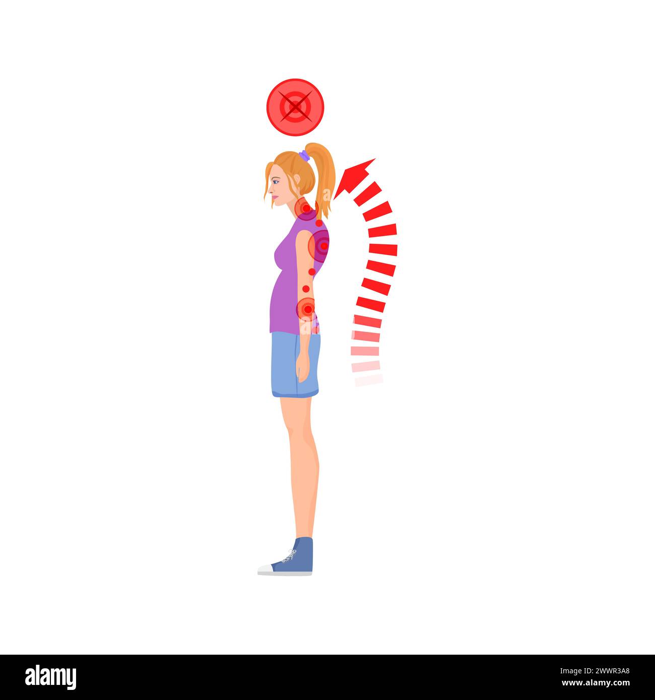 Standing woman with incorrect spine posture. Spine health, bad body ...