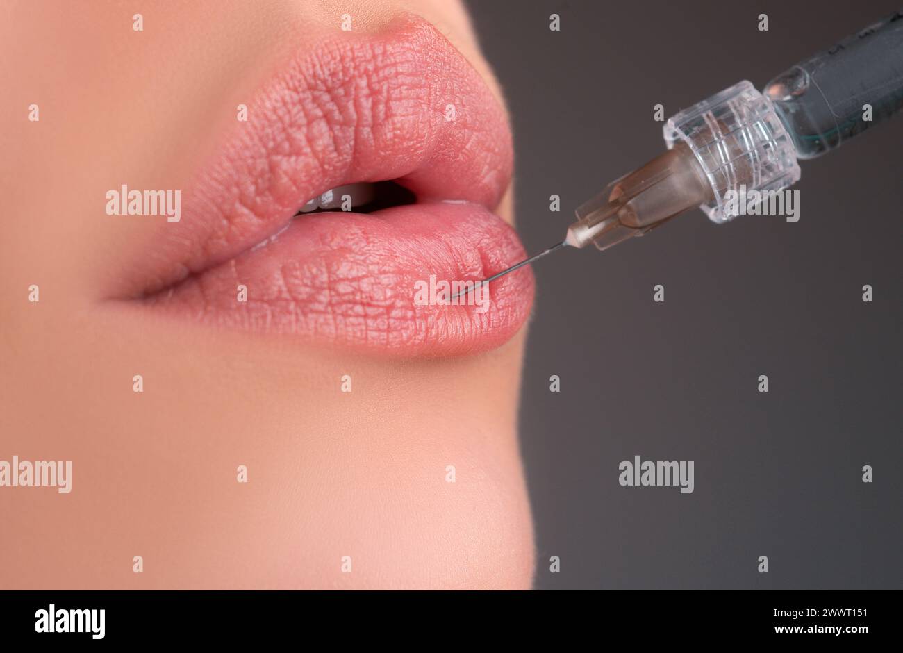 Lips augmentation. Syringe female mouth, hyaluronic acid injection. Age ...