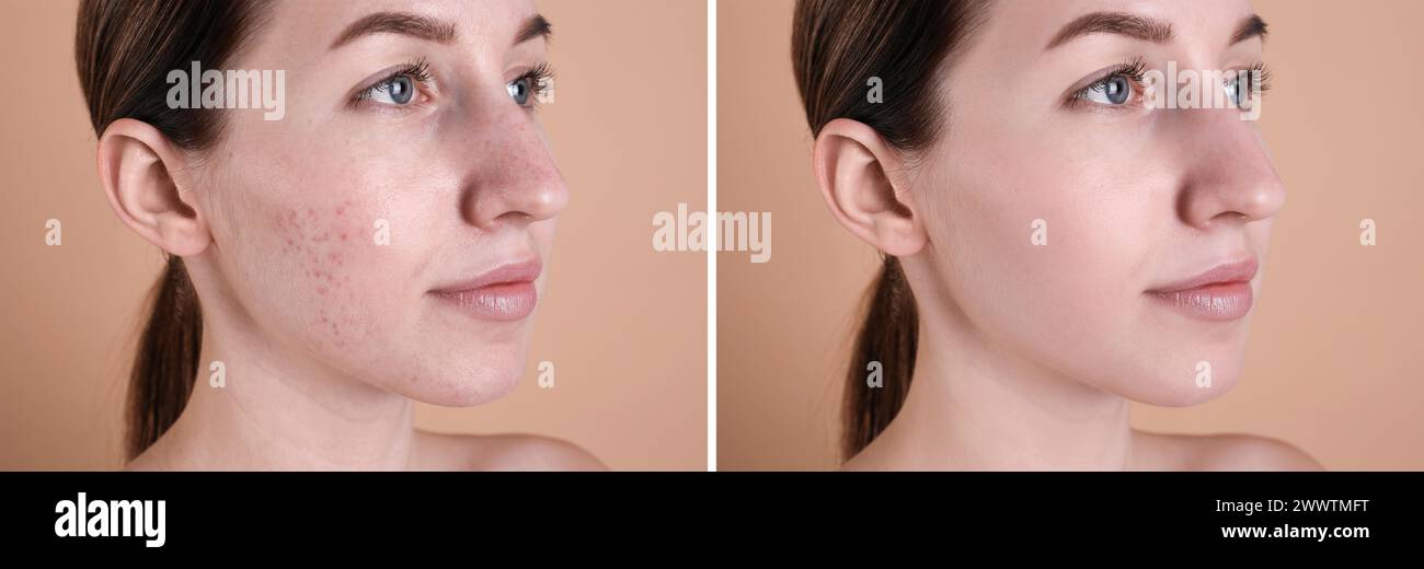 Acne problem. Young woman before and after treatment on beige ...
