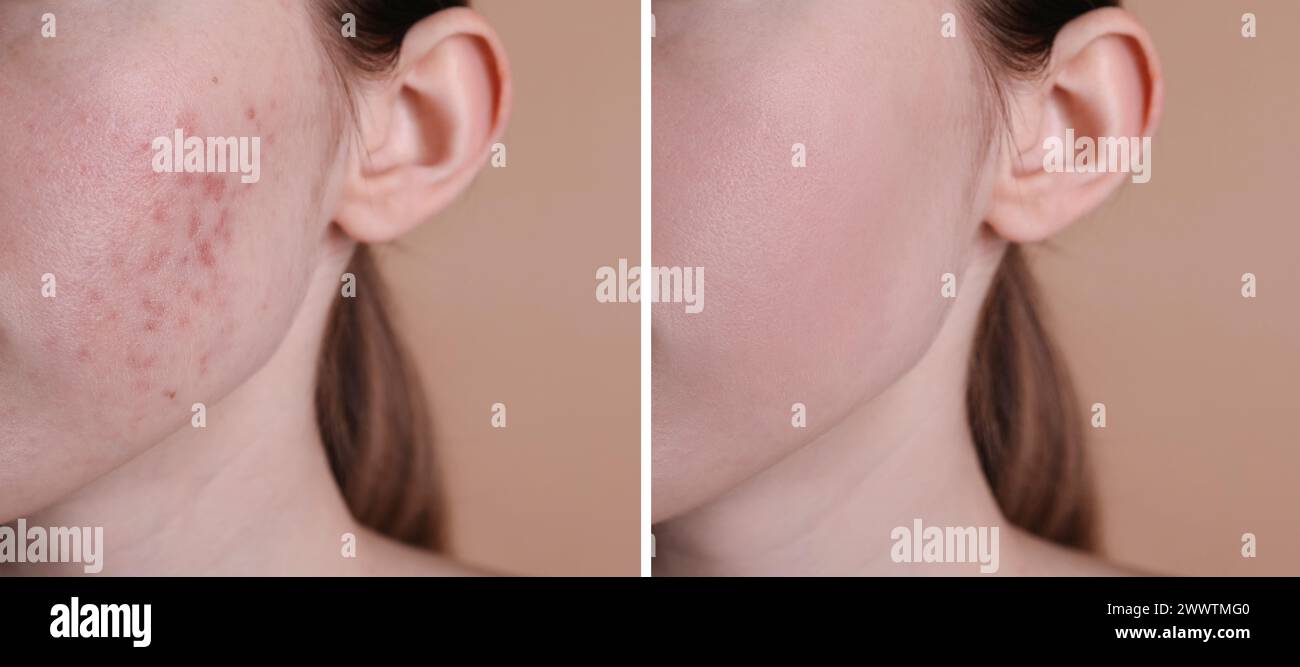 Acne problem. Young woman before and after treatment on beige ...