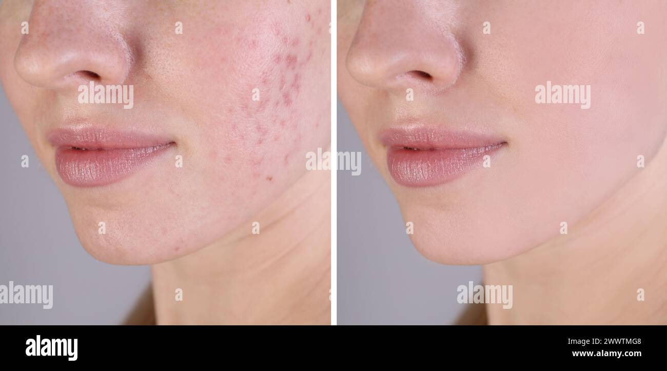 Acne problem. Young woman before and after treatment on grey background ...