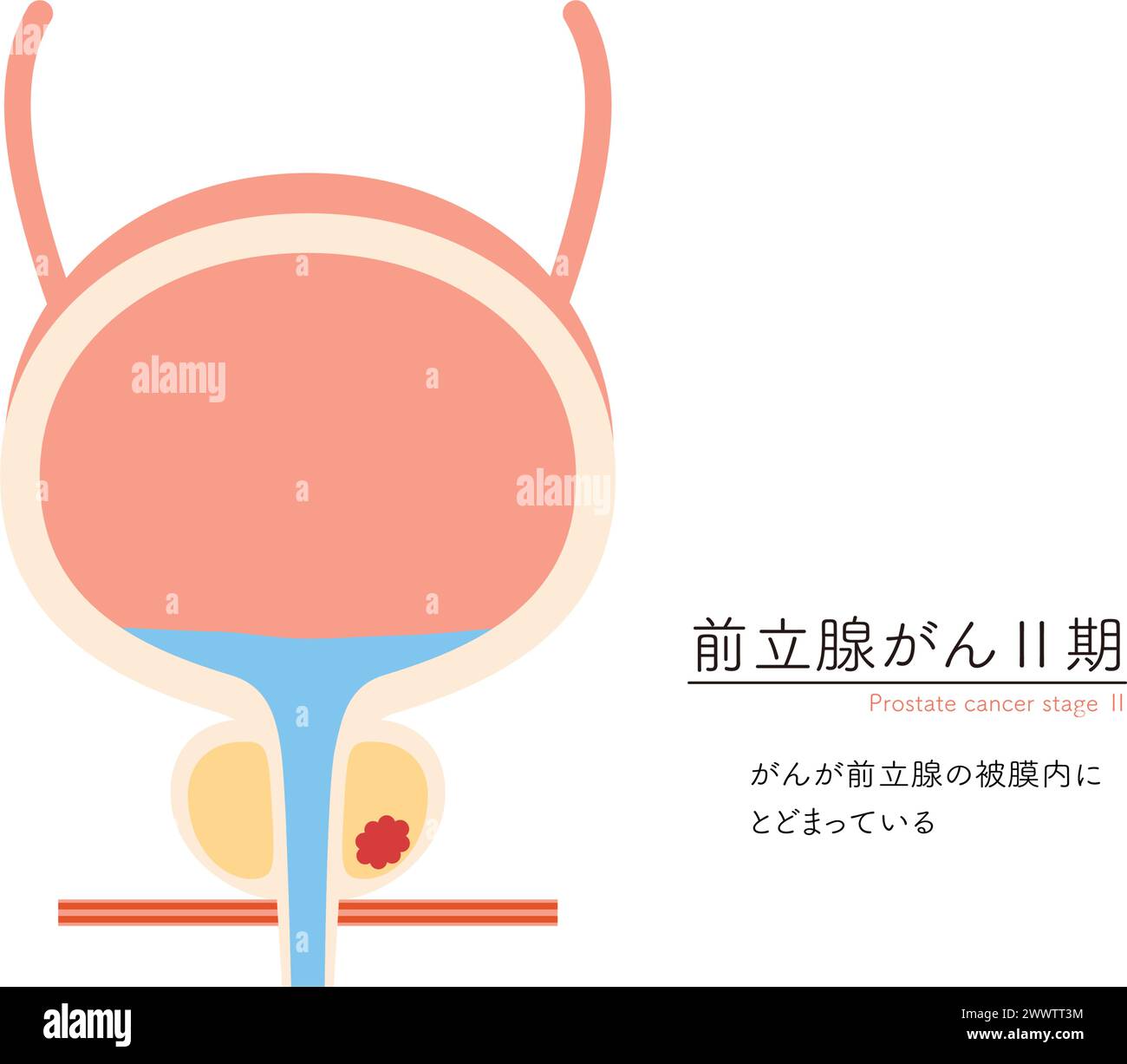 Medical Illustration of Prostate, Stage 2 Prostate Cancer - Translation ...