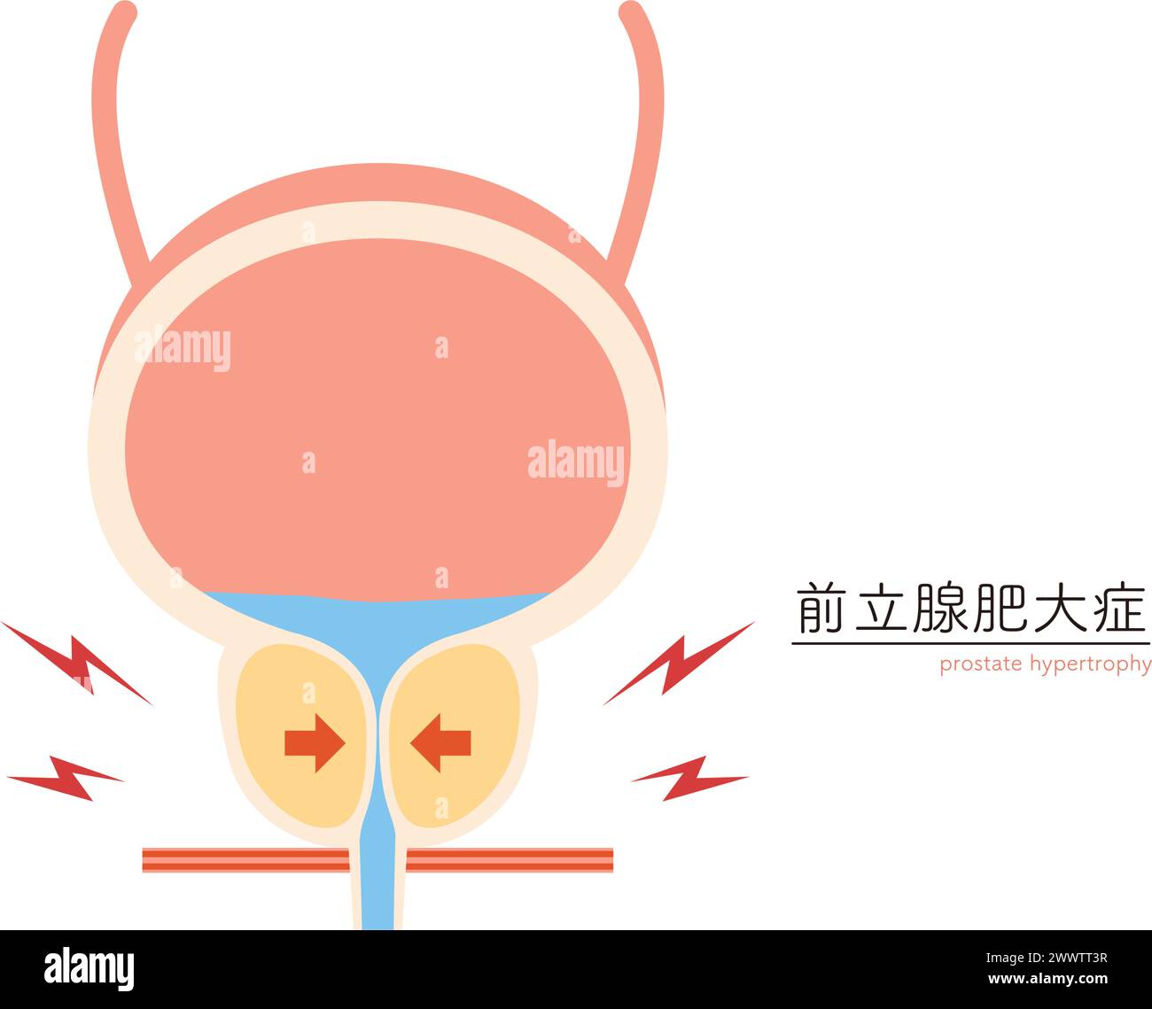 Medical illustration of benign prostatic hyperplasia, normal vs ...