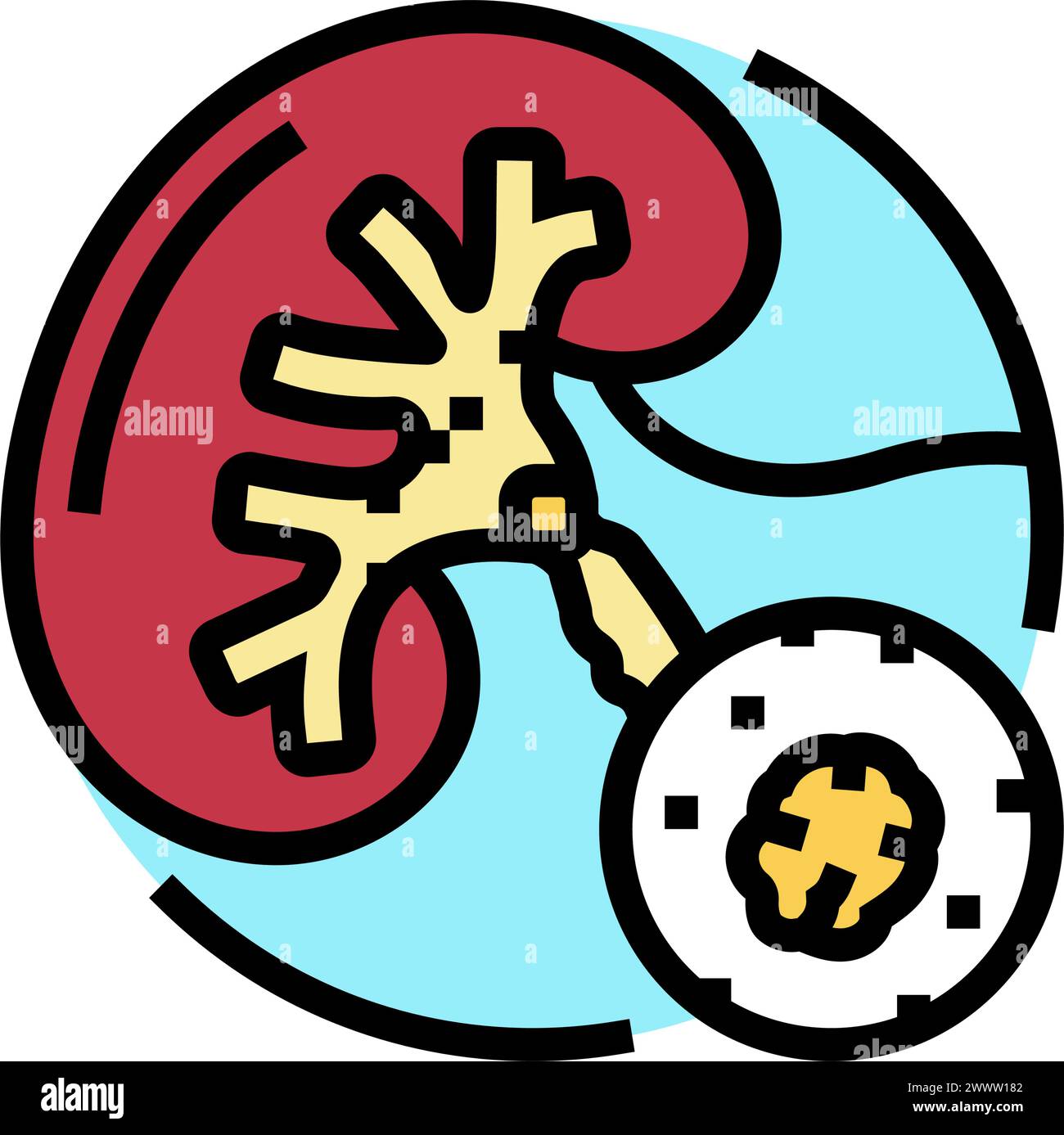 Urolithiasis disease Cut Out Stock Images & Pictures - Alamy