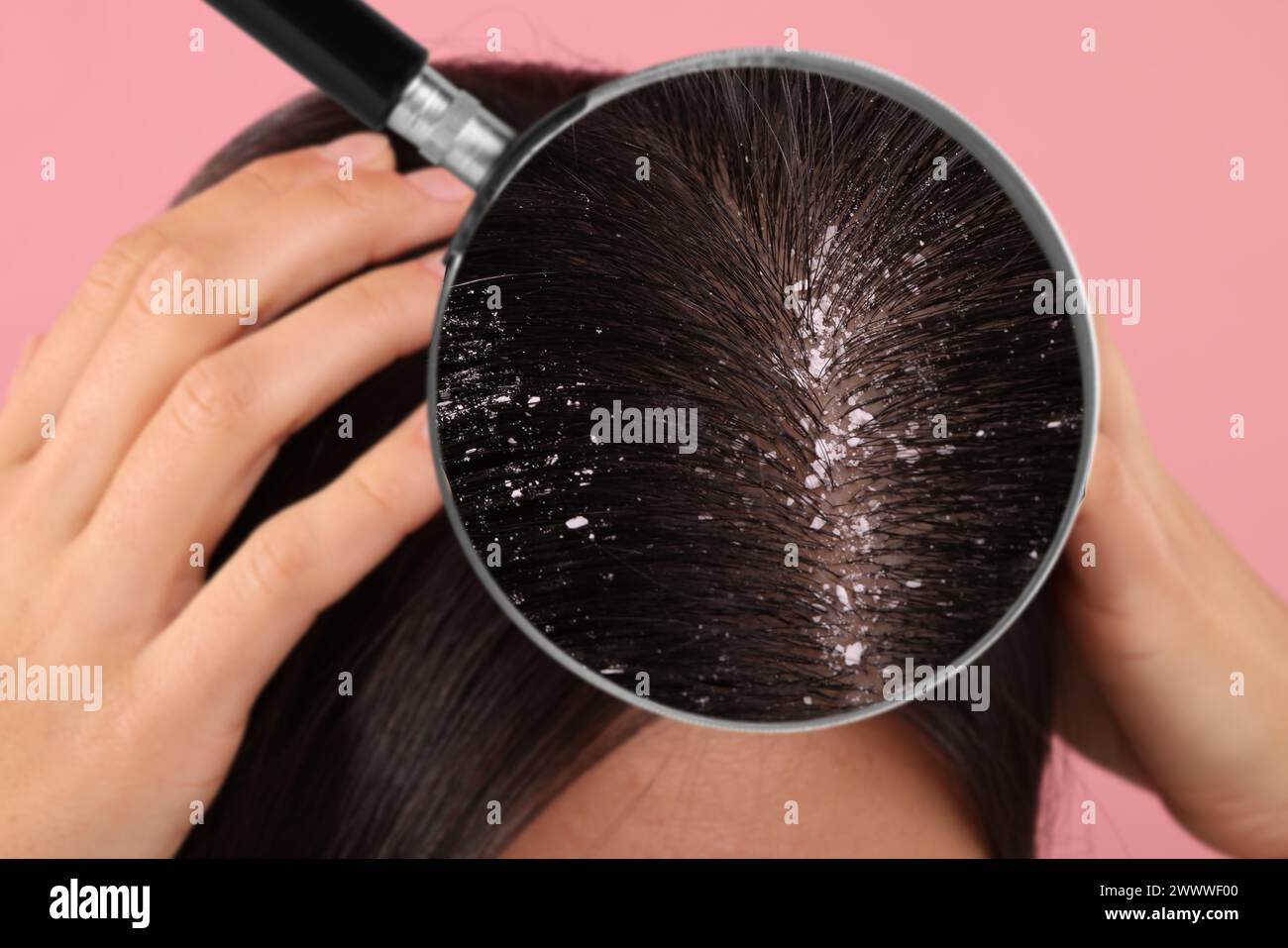 Woman suffering from dandruff on pink background, closeup. View through ...