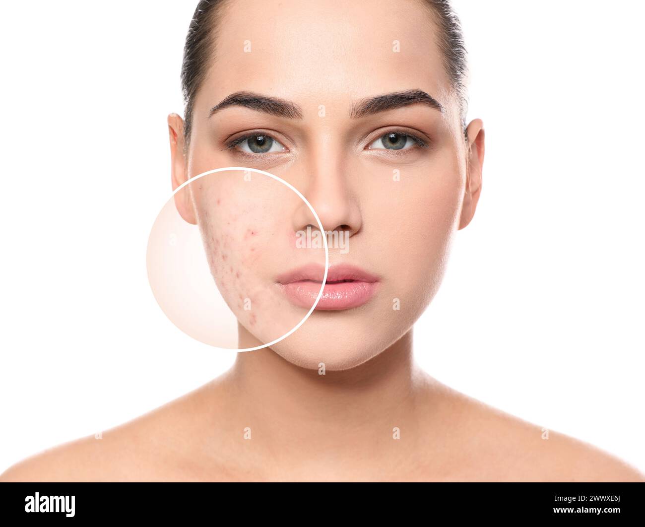 Woman with acne on her face on white background. Zoomed area showing ...