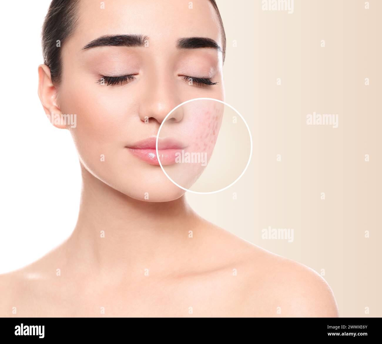 Woman with acne on her face on beige gradient background. Zoomed area ...
