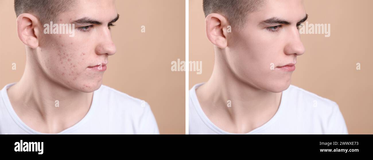 Acne problem. Young man before and after treatment on beige background ...