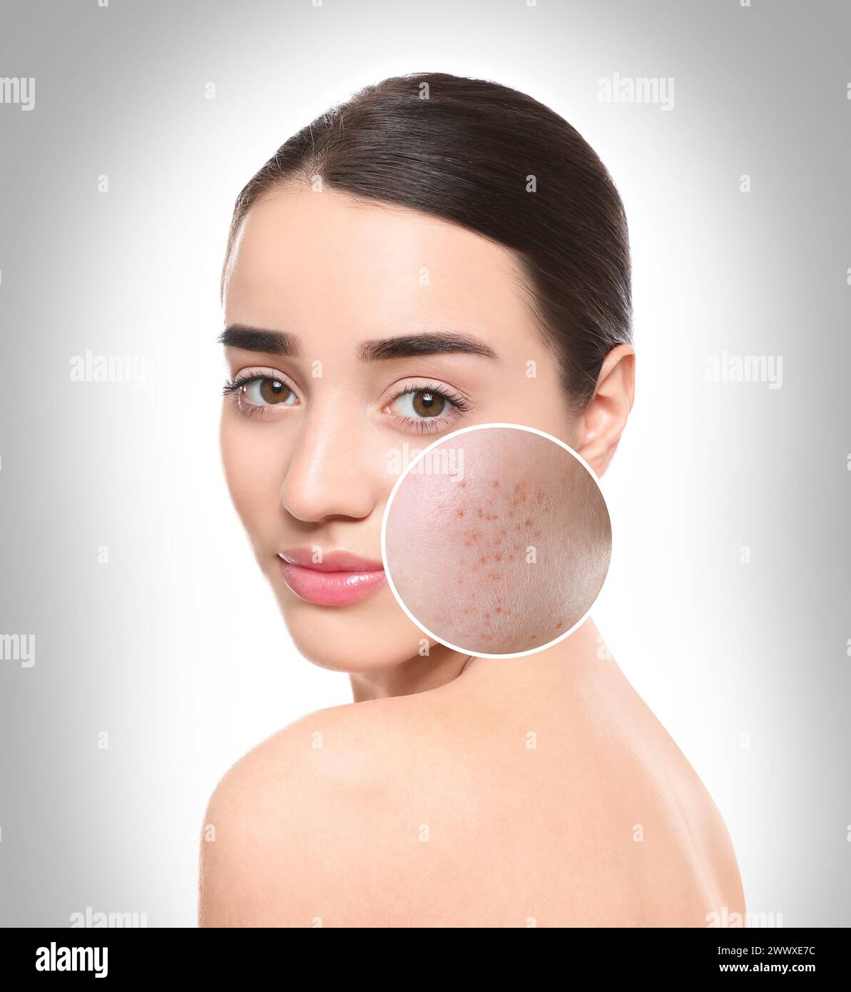 Woman with acne on her face on grey gradient background. Zoomed area showing problem skin Stock ...