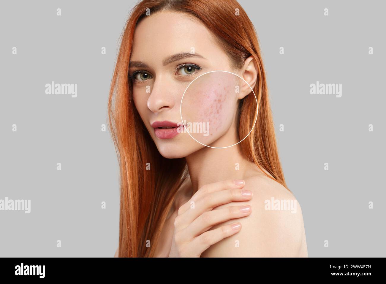 Woman with acne on her face on grey background. Zoomed area showing ...