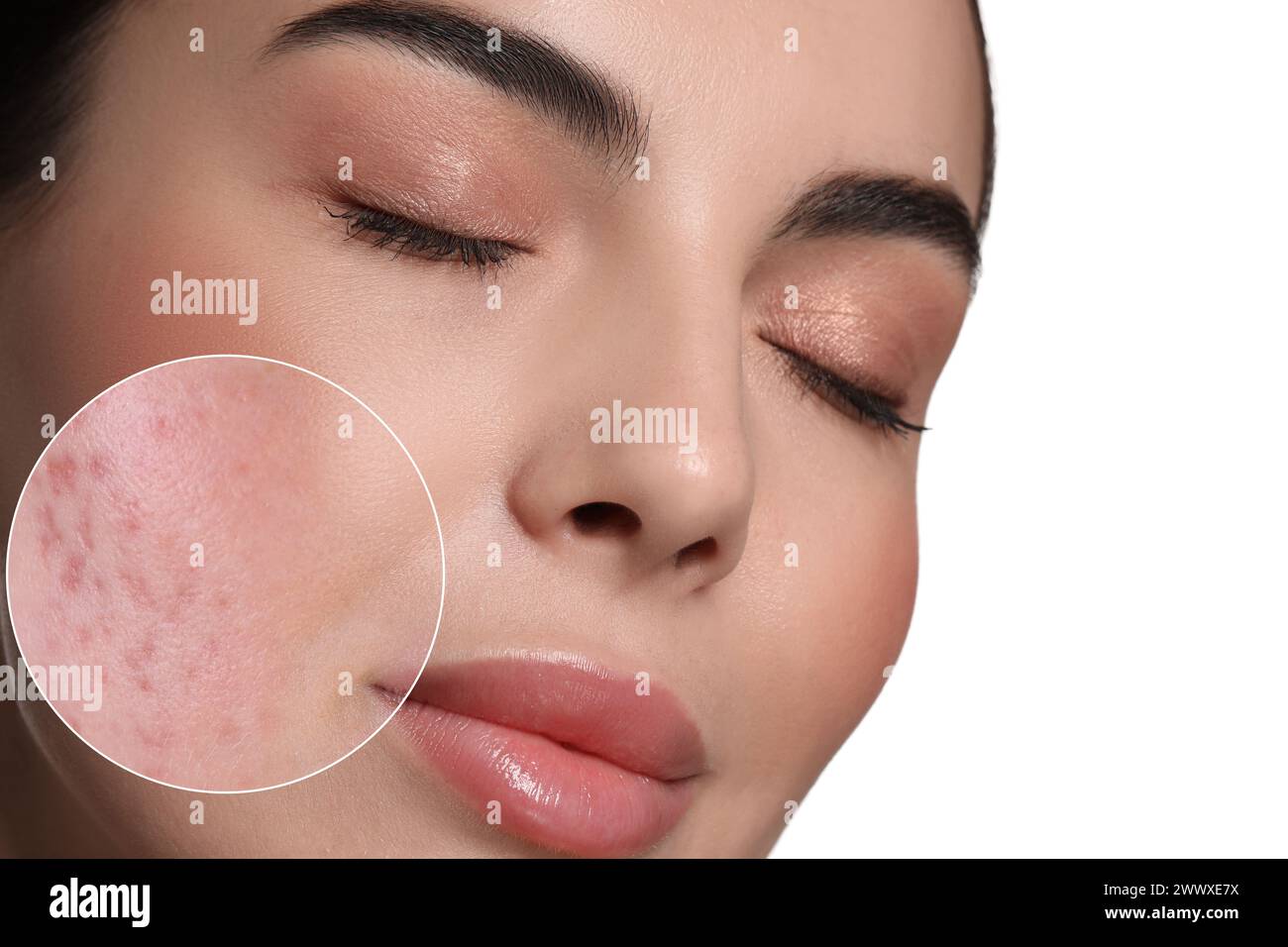 Woman with acne on her face on white background. Zoomed area showing ...