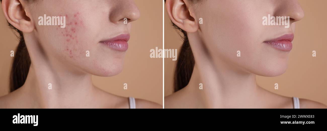 Acne problem. Young woman before and after treatment on beige ...