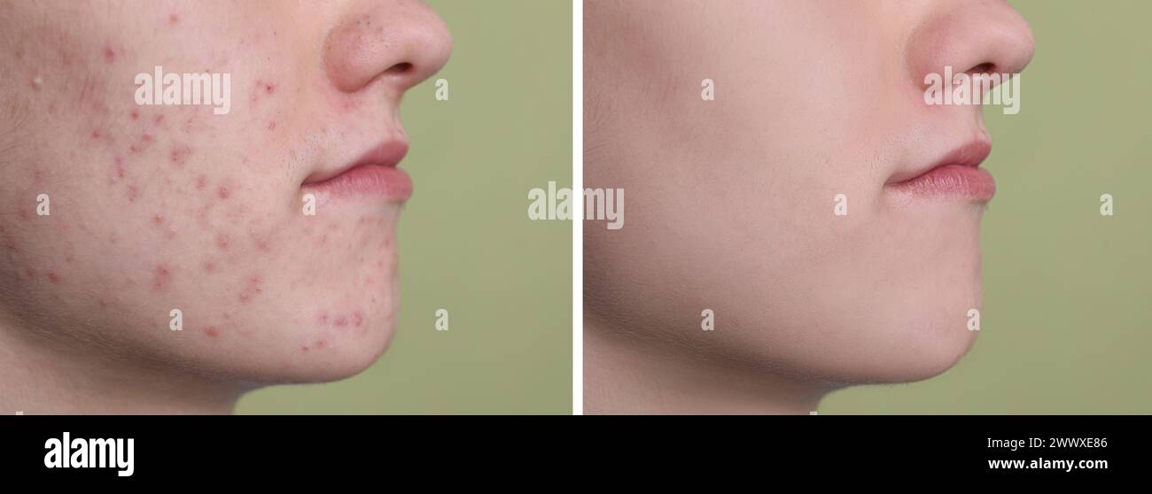 Acne problem. Young man before and after treatment on green background ...