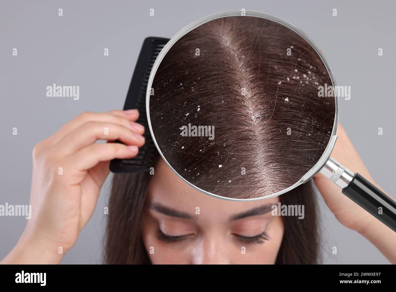 Woman suffering from dandruff on grey background, closeup. View through ...