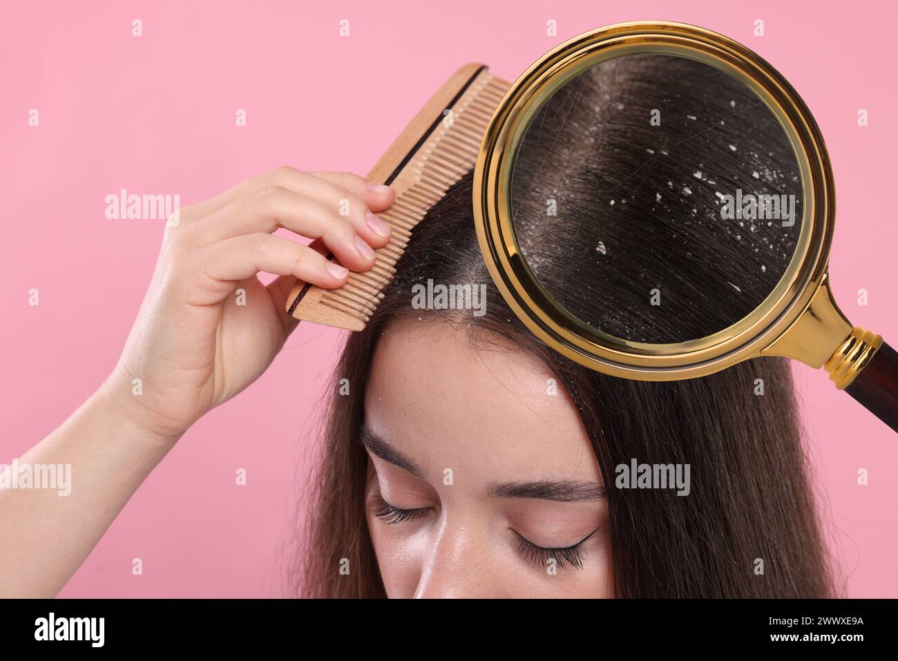 Woman suffering from dandruff on pink background, closeup. View through ...