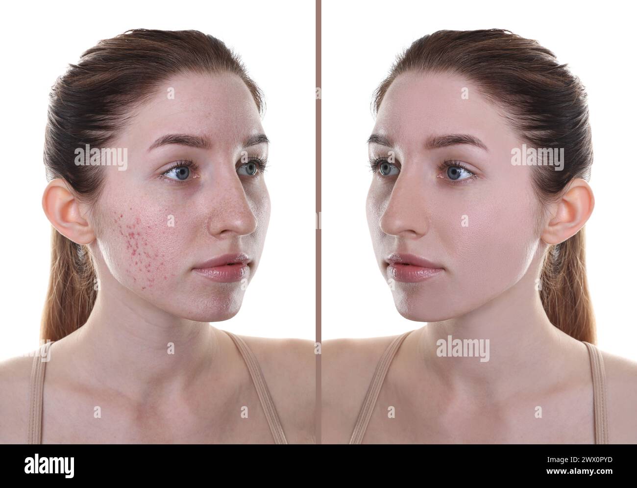 Acne problem. Young woman before and after treatment on white ...