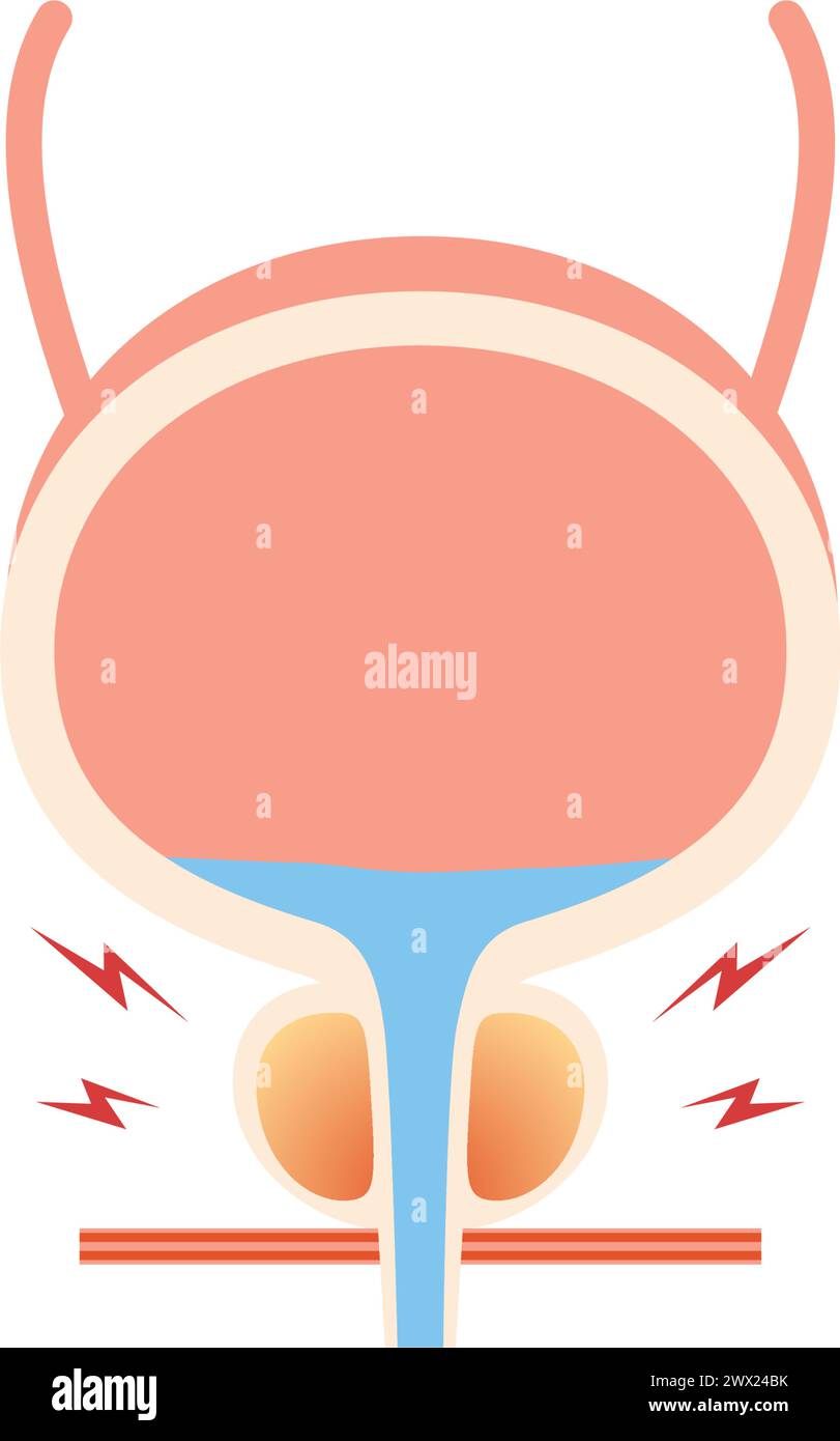 Medical Illustration of Prostate, Prostatitis, Vector Illustration ...