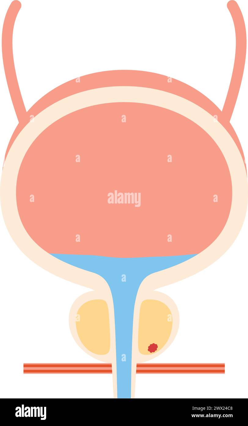 Medical Illustration of Prostate, Stage 1 Prostate Cancer, Vector ...