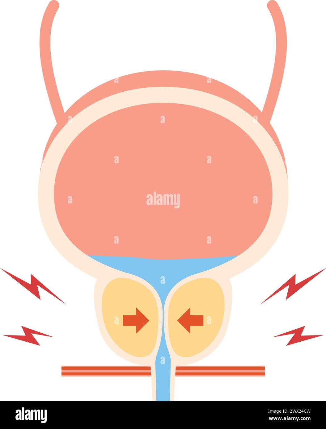 Medical illustration of benign prostatic hyperplasia, normal vs ...