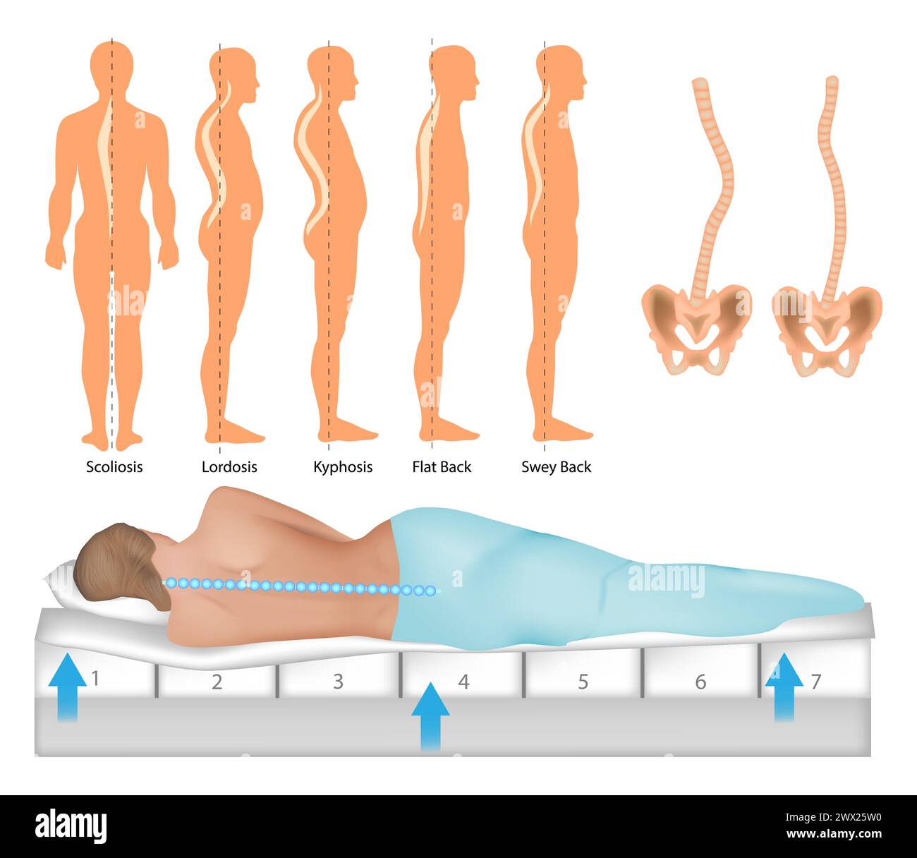 Orthopedic Mattress. Curvature Of Human Spine. Influence of Mattress ...