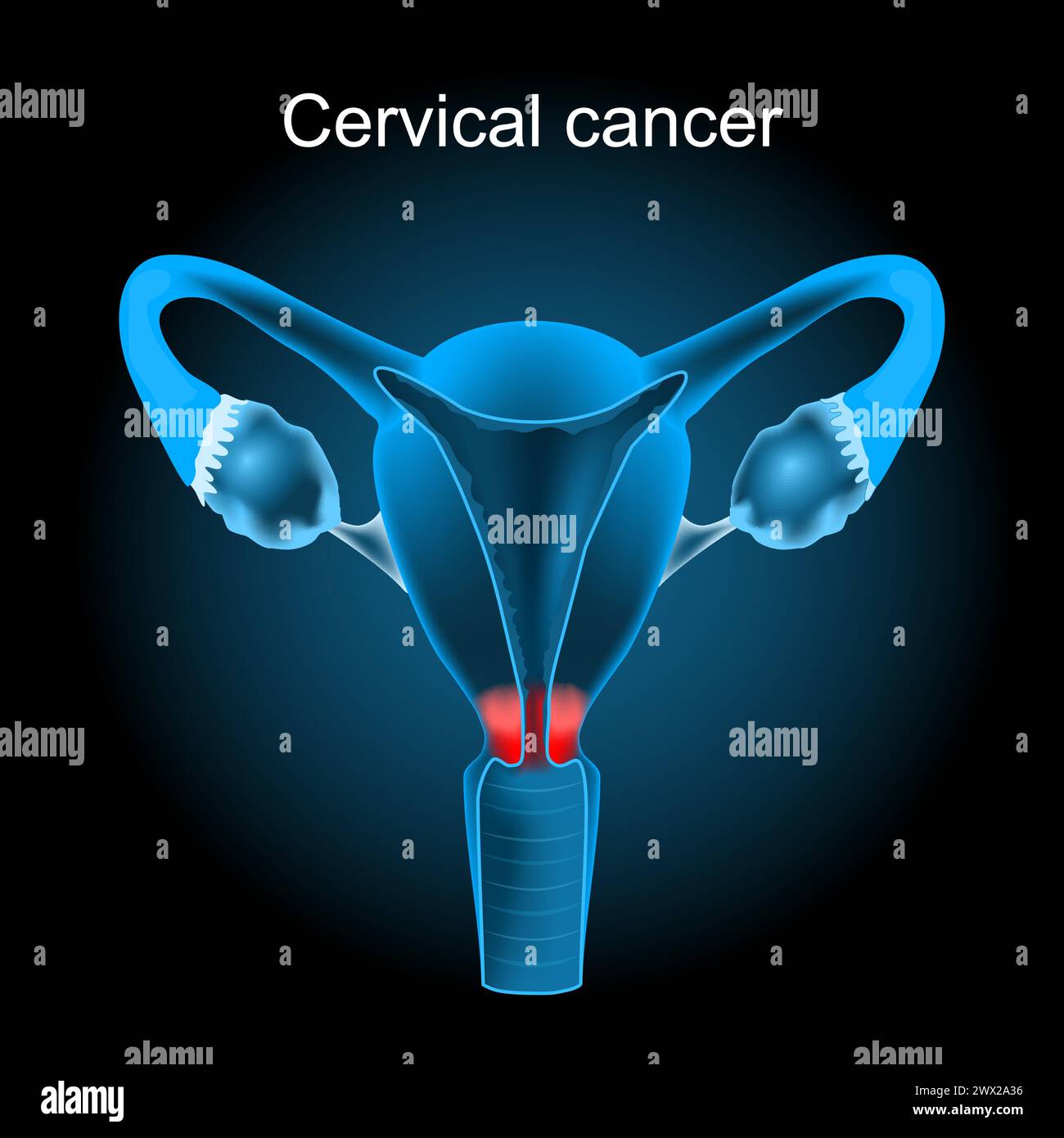 Cervical Cancer Carcinoma Malignant Neoplasm Cut Away View Of The