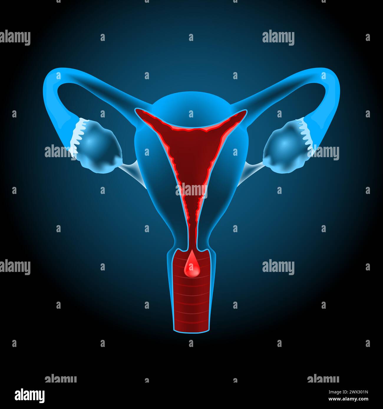 Uterine bleeding. Menstruation. Cut-away view of the uterus. female ...