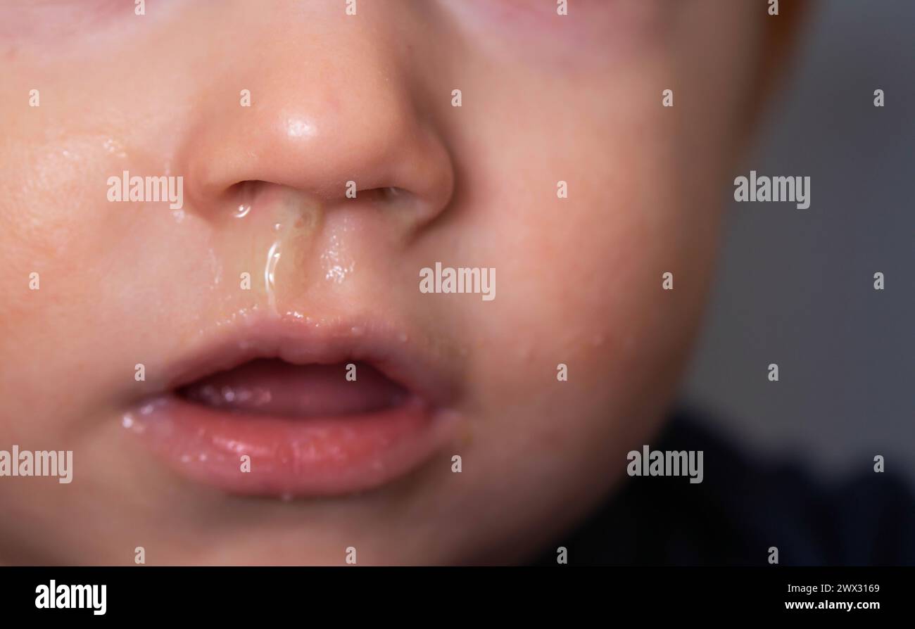 Close-up of a small child's face and nose with snot. The concept of ...
