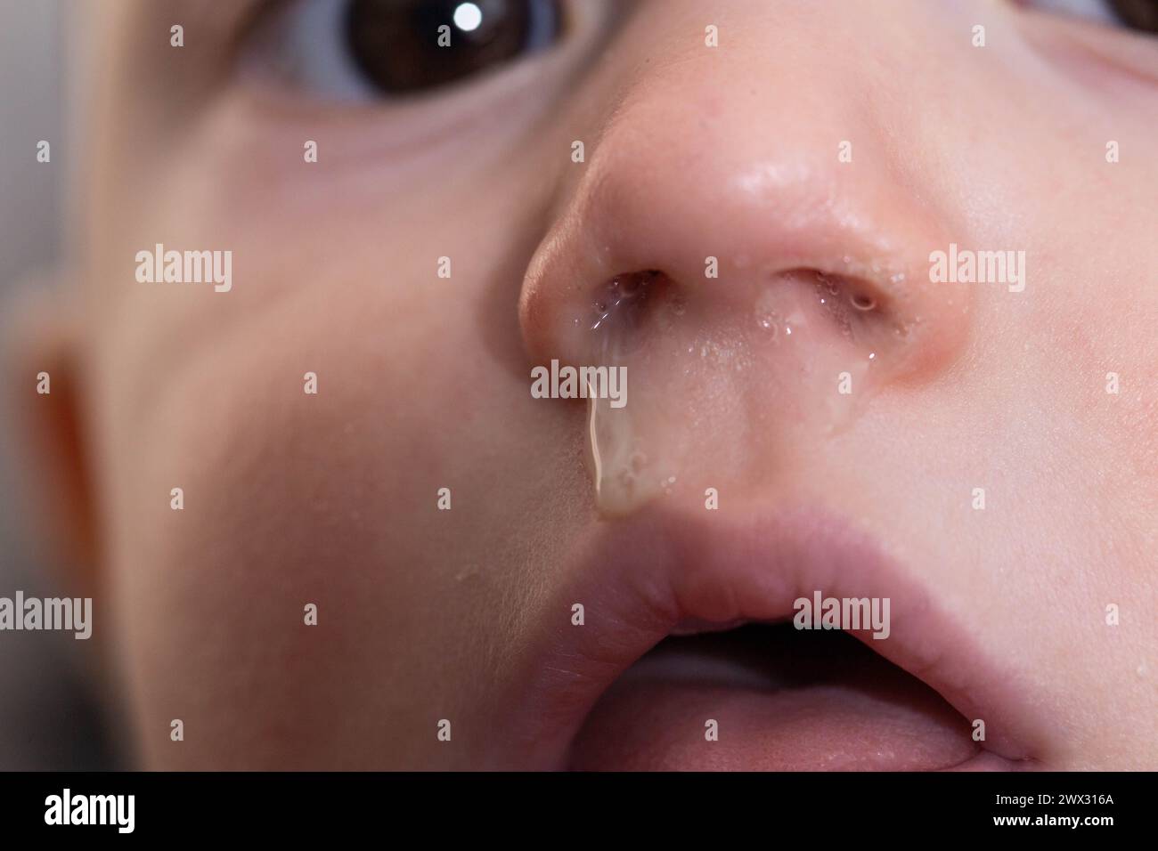 Chronic tonsillitis hi-res stock photography and images - Alamy