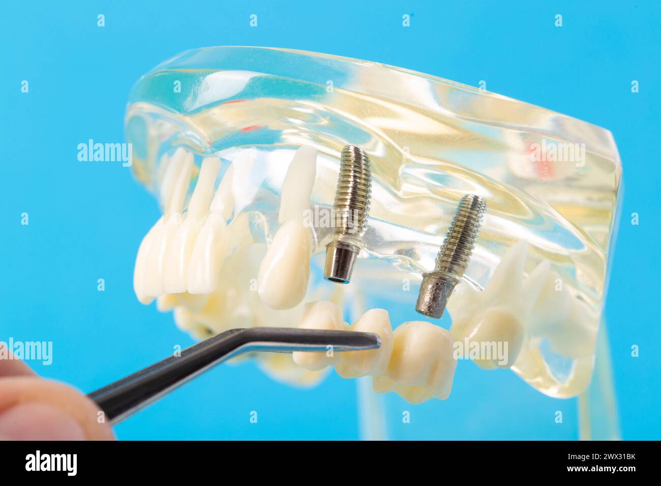 Dental bridge in tweezers against the background of a medical model of ...