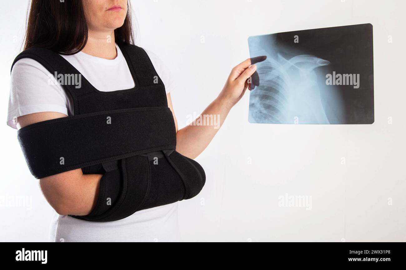 A girl holds an X-ray of a dislocation and fracture of the humerus in a ...