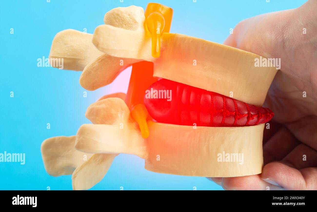 Red inflamed spine with a compressed nerve root, close-up. Neuralgia ...