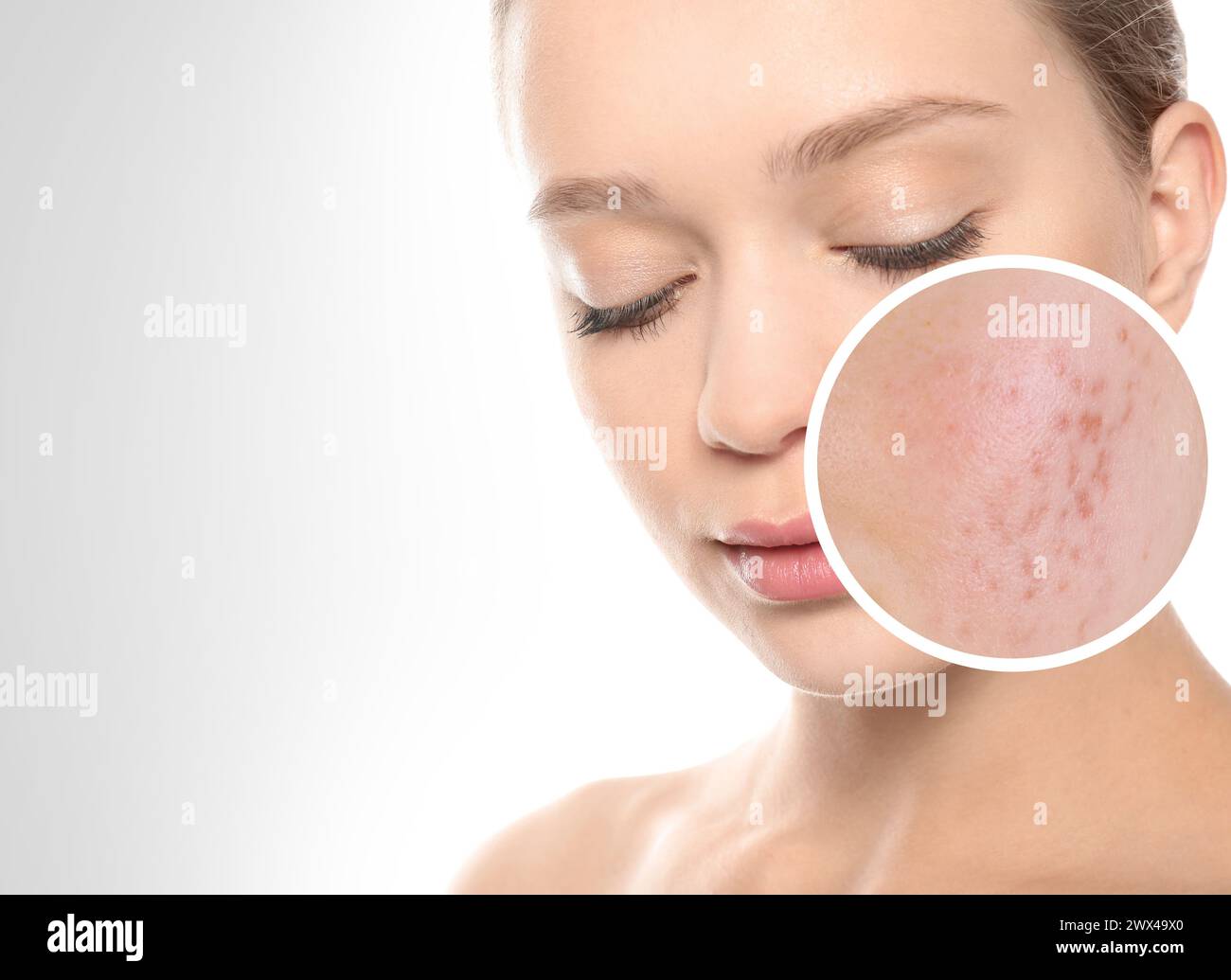Woman with acne on her face on light background, space for text. Zoomed ...