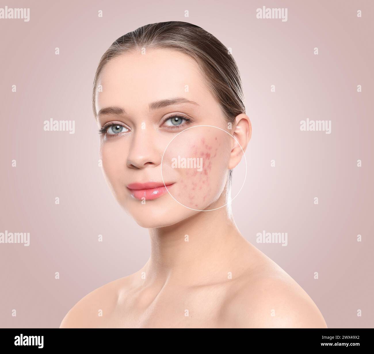 Woman with acne on her face on beige background. Zoomed area showing ...