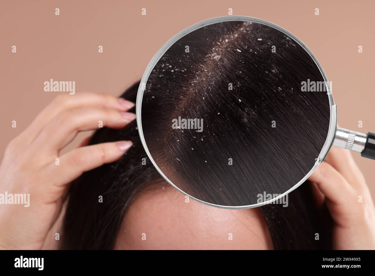 Woman suffering from dandruff on pale brown background, closeup. View ...