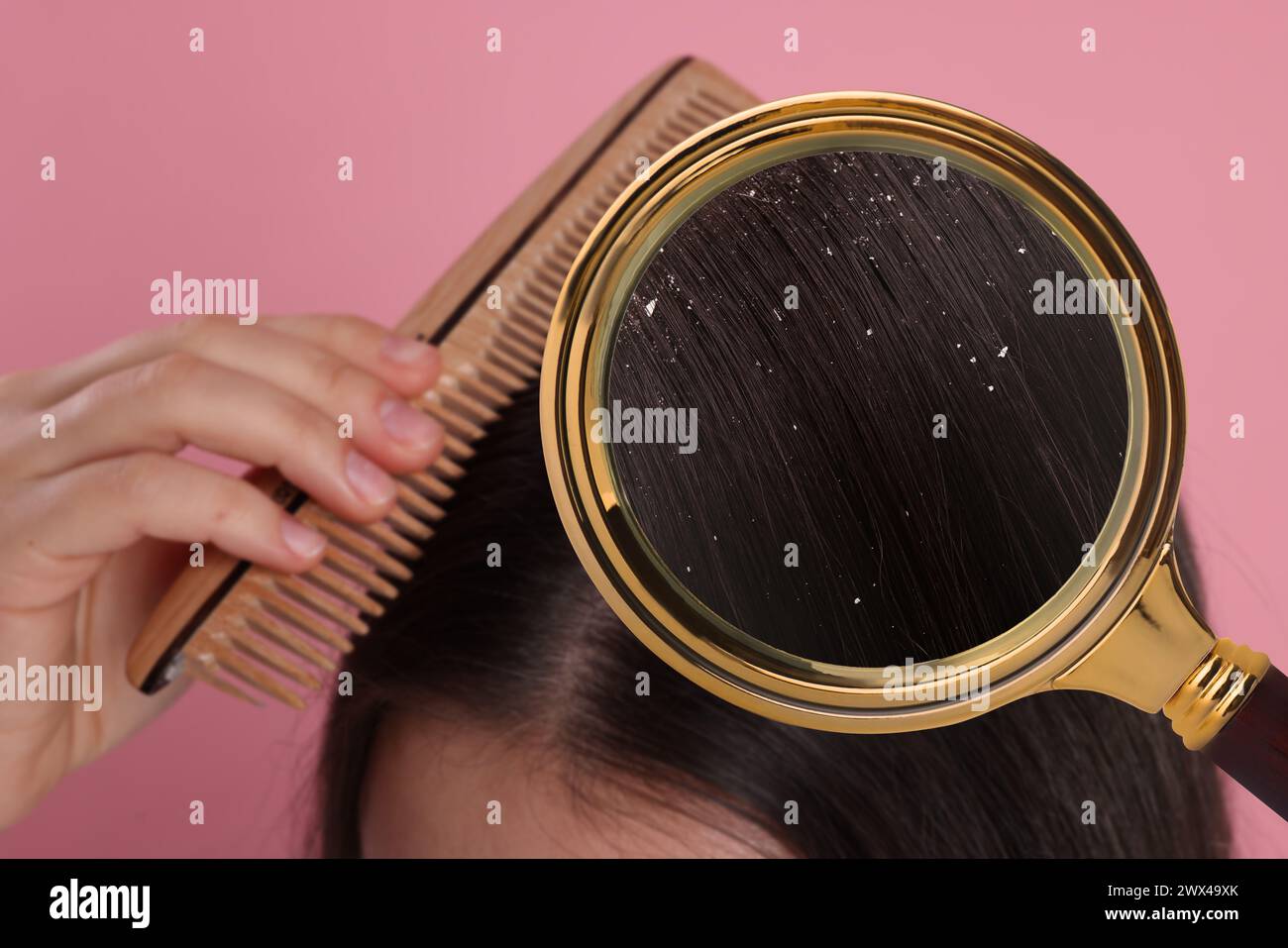 Woman suffering from dandruff on pink background, closeup. View through ...